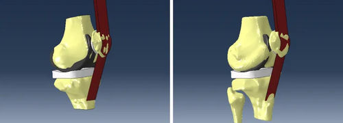 Analysis software - Abaqus Knee Simulator - SIMULIA - simulation / modeling / design